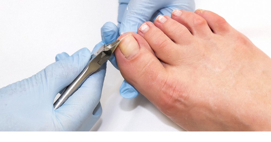 Cómo prevenir las uñas encarnadas o uñeros - La Noticia SV